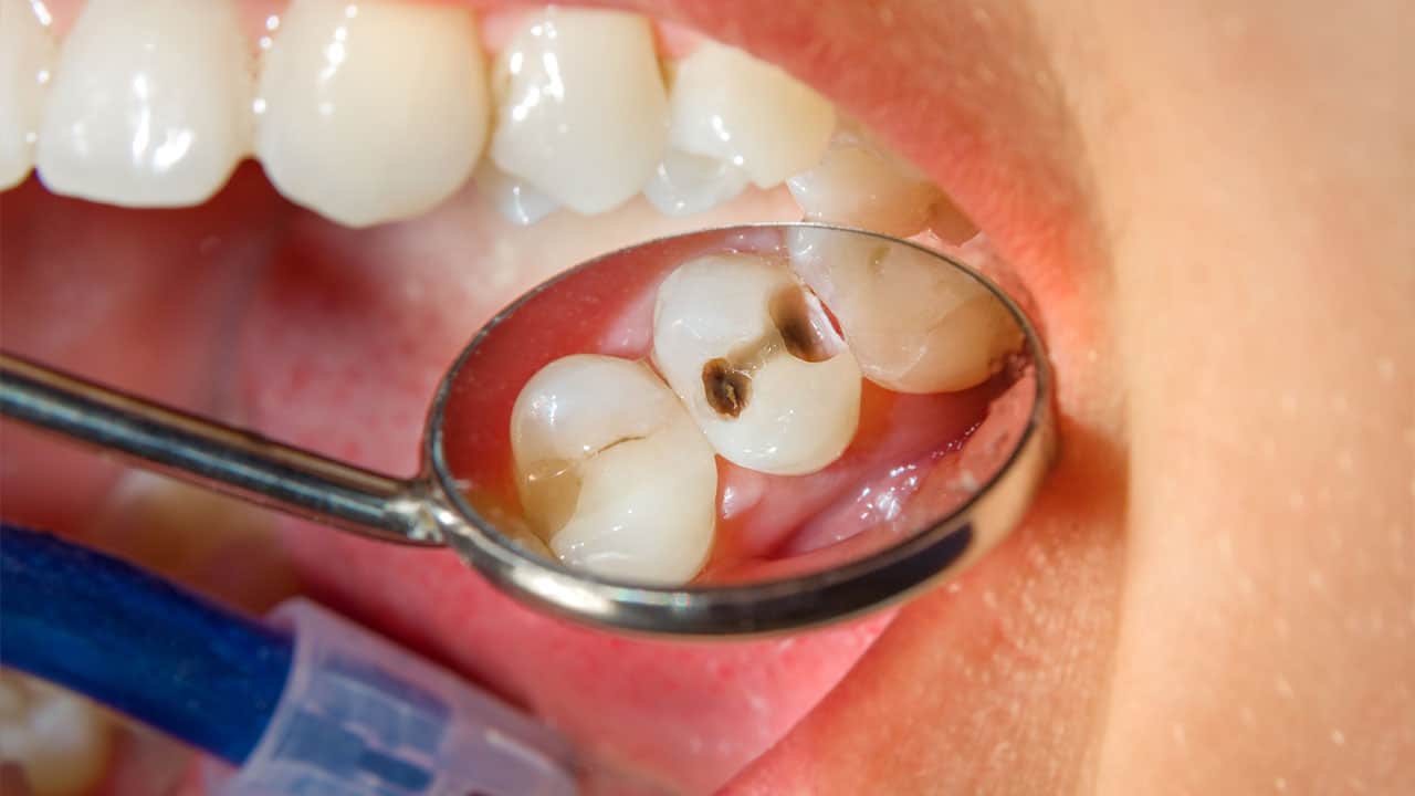 The Science Behind Tooth Decay: How Cavities Form - Aurora Dental Group